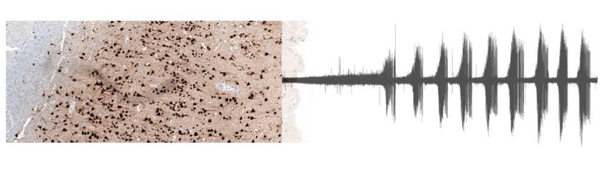 “Live” human brain biosamples to revolutionise translational ...